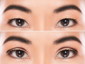 What Are Double Eyelids? - In Focus Ophthalmic Plastic Surgery - Blog